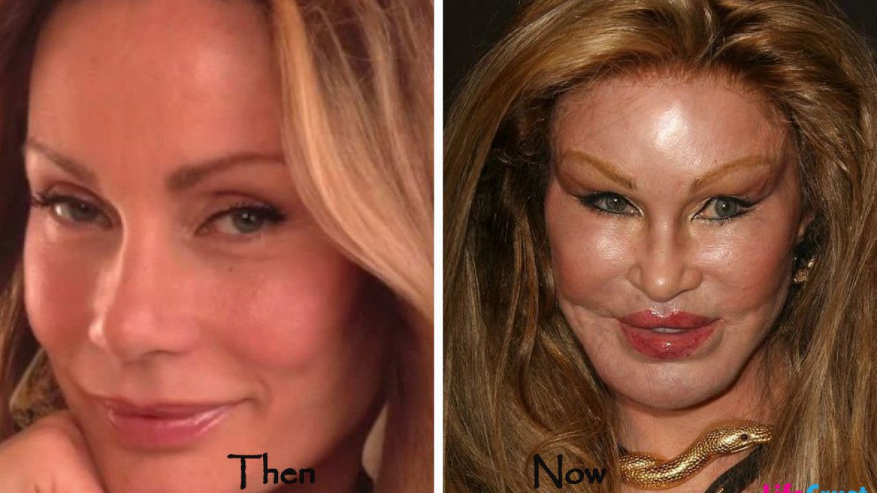 Plastic Surgery Gone Wrong Before And After Pictures