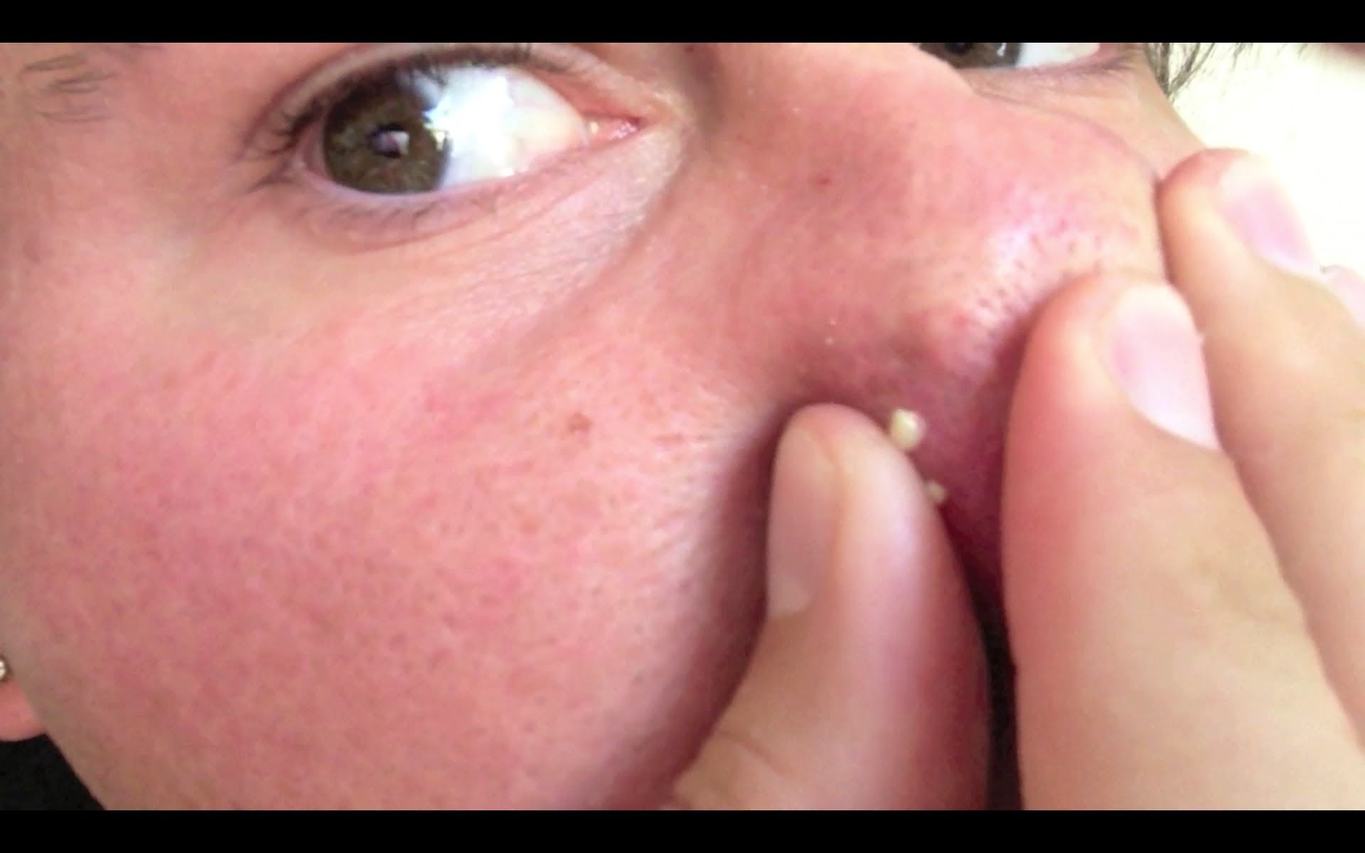 What Your Acne Is Telling You!! | LifeCrust